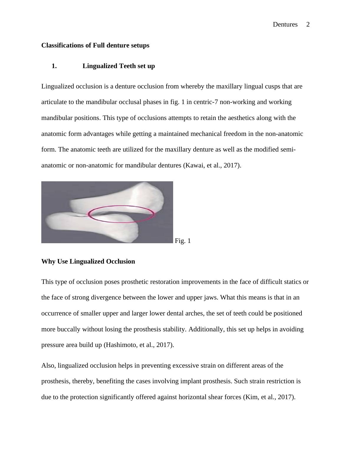Full Dentures: Classifications and Teeth Placement